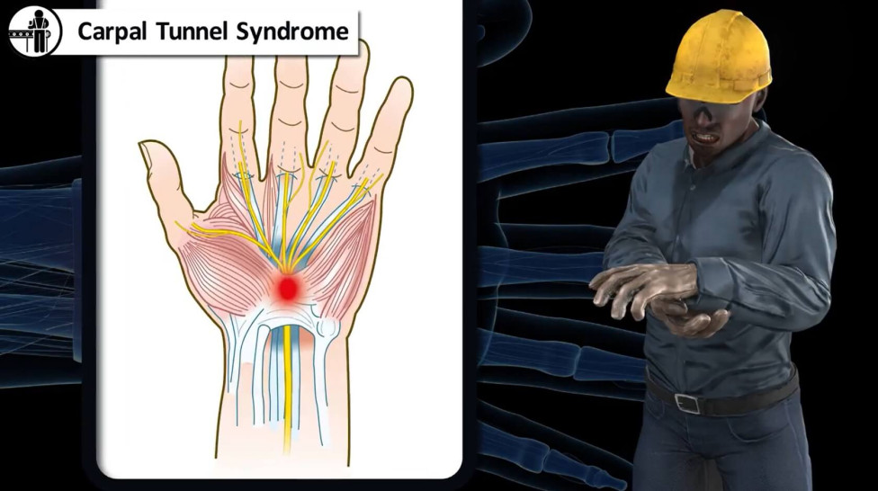 Industrial Ergonomics: Musculoskeletal Disorders (SNP-116.2) - HSI